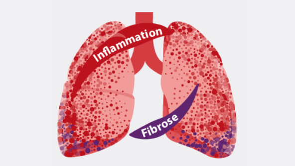 Inflammation et fibrose | Boehringer Ingelheim Pro