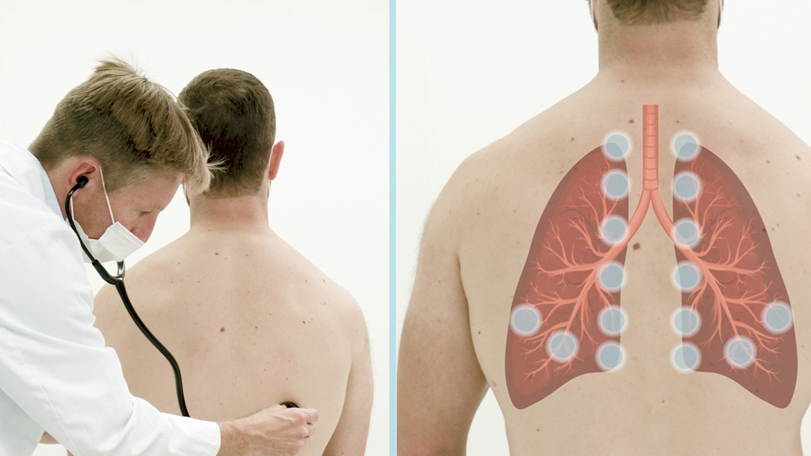 IPF | Boehringer Ingelheim