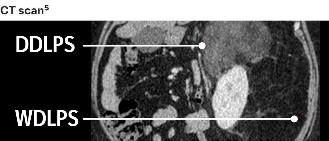 Diagnosis and Testing of DDLPS | Boehringer Ingelheim