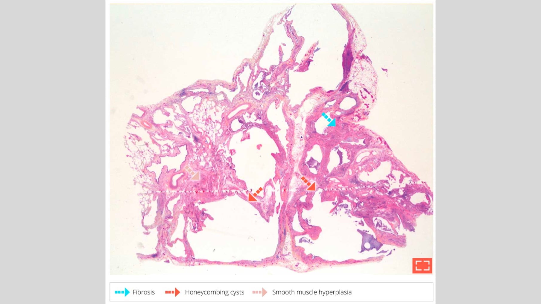 Architectural distorsion-Elementary Lesions| Imaging