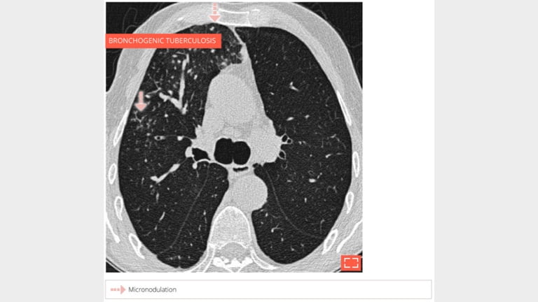 Micronodulation - Elementary Lesions | Imaging Atlas