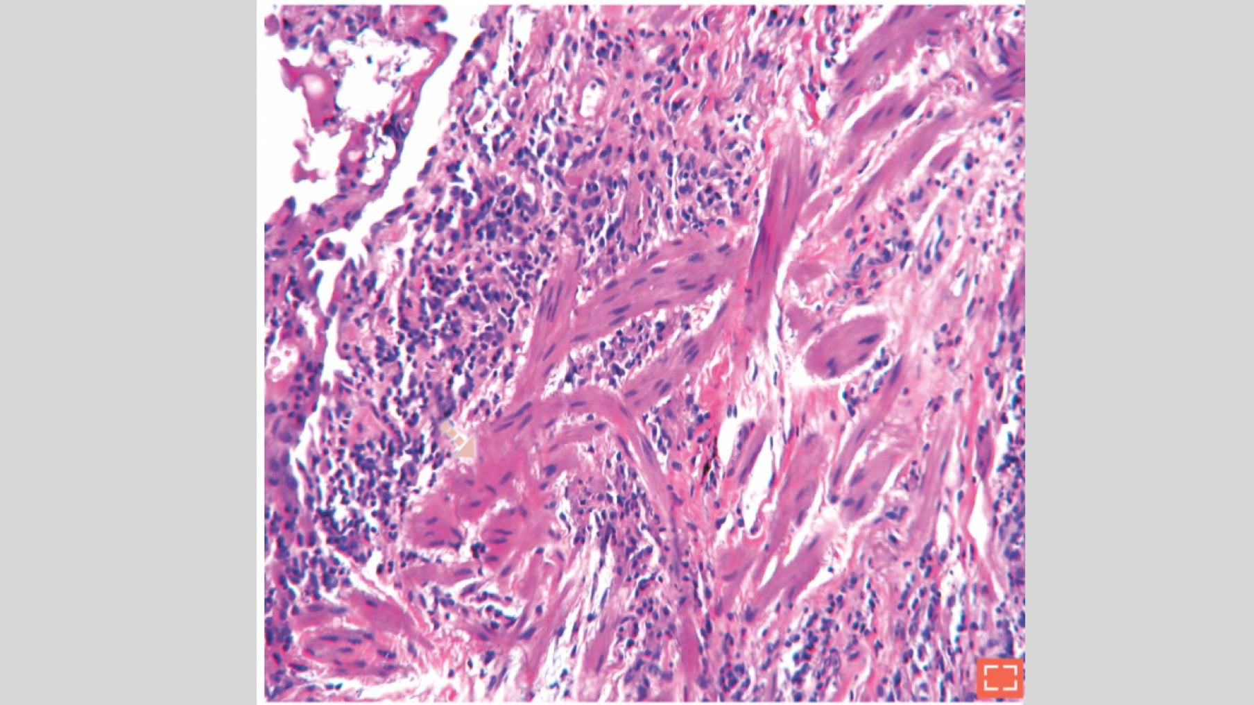 Smooth muscle hyperplasia (I) | Imaging Atlas