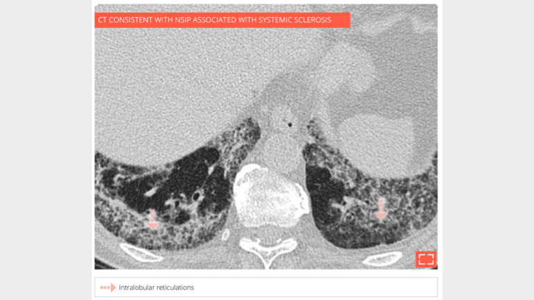 Intralobular reticulations (lines) | Imaging Atlas