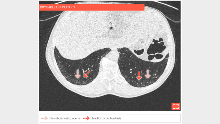 Intralobular reticulations (lines) | Imaging Atlas