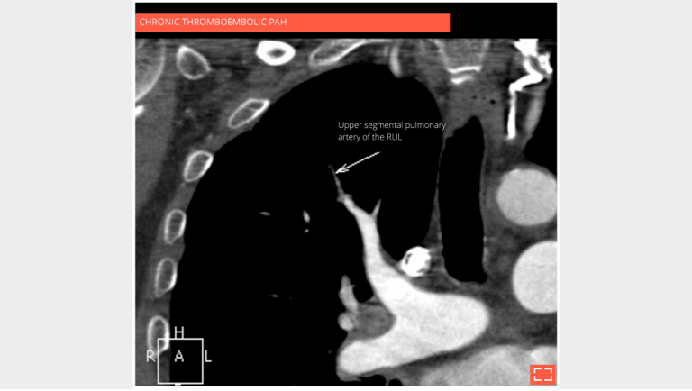 Mosaic Attenuation Pattern Imaging Atlas