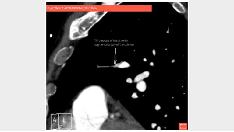 Mosaic Attenuation Pattern Imaging Atlas