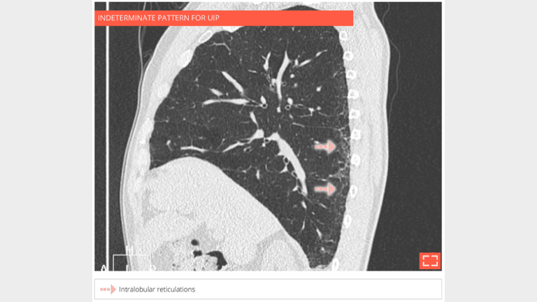 Intralobular reticulations (lines) | Imaging Atlas
