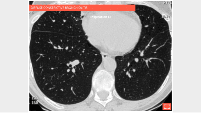 Mosaic attenuation pattern | Imaging Atlas