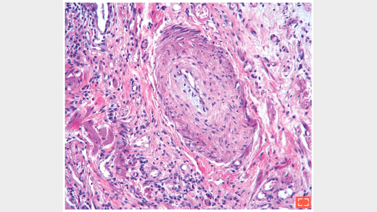 Vascular changes | Boehringer Ingelheim | Imaging Atlas