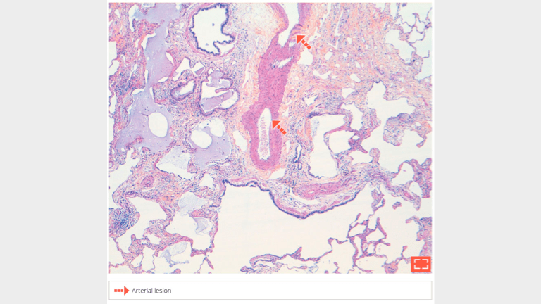 Vascular changes | Boehringer Ingelheim | Imaging Atlas