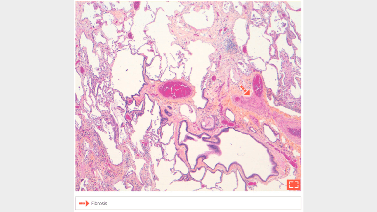 Vascular changes | Boehringer Ingelheim | Imaging Atlas