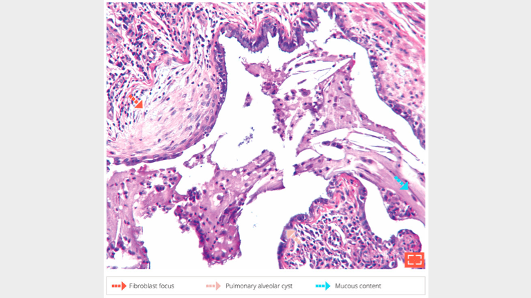 Fibroblast focus | Boehringer Ingelheim | Imaging Atlas