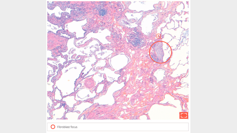 Fibroblast focus | Boehringer Ingelheim | Imaging Atlas