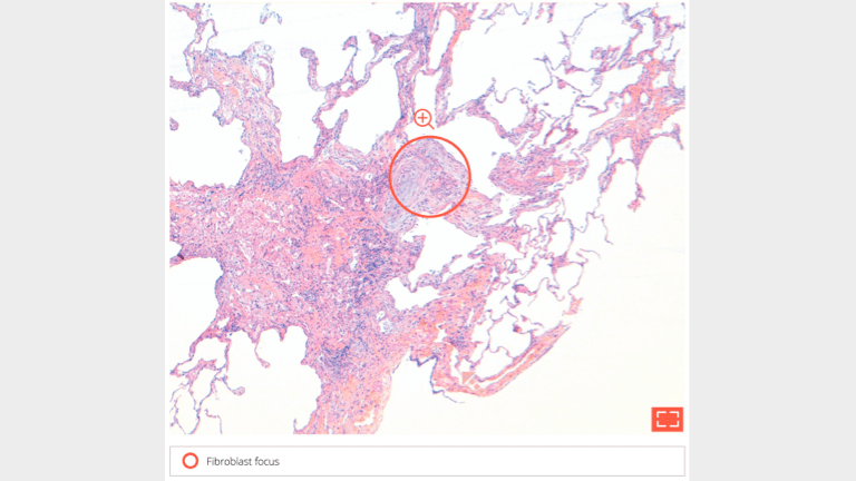 Fibroblast focus | Boehringer Ingelheim | Imaging Atlas