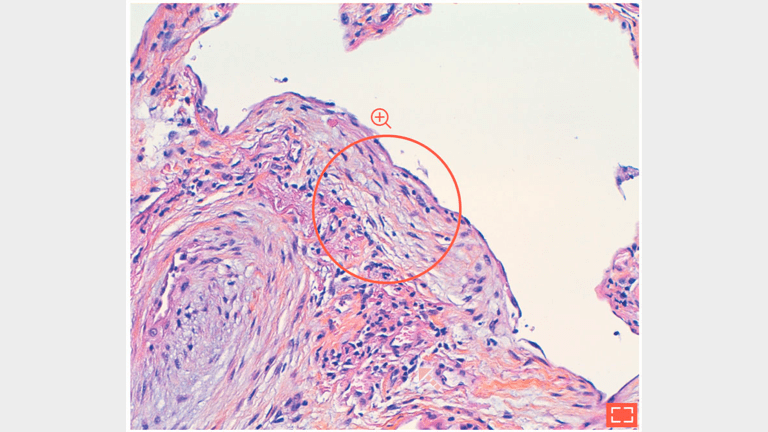 Fibroblast focus | Boehringer Ingelheim | Imaging Atlas