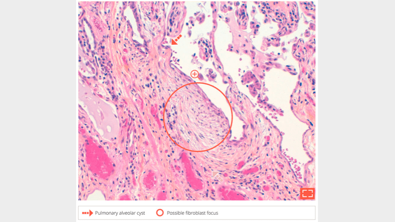 Fibroblast focus | Boehringer Ingelheim | Imaging Atlas