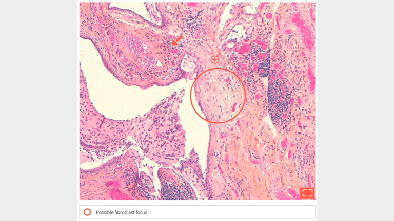 Fibroblast focus | Boehringer Ingelheim | Imaging Atlas