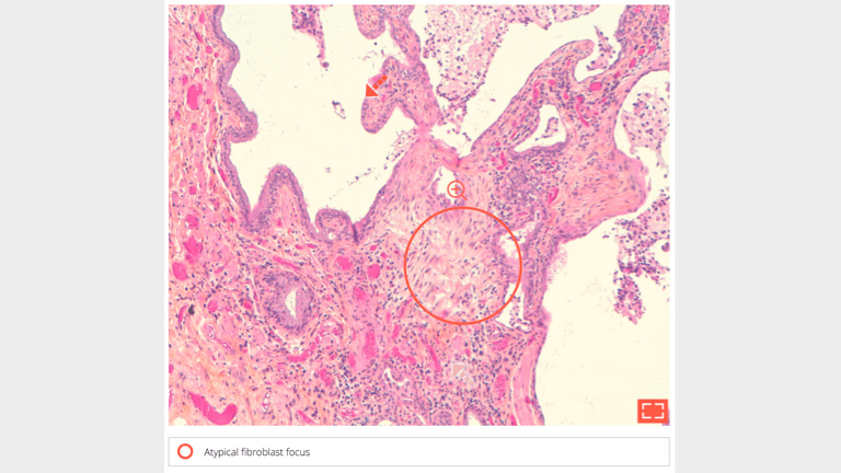 Fibroblast focus | Boehringer Ingelheim | Imaging Atlas