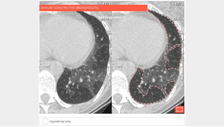 Mosaic attenuation pattern | Imaging Atlas