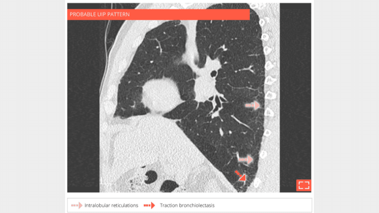 Intralobular reticulations (lines) | Imaging Atlas