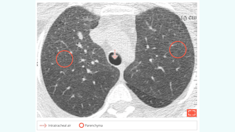 Ground-glass opacity-Elementary Lesions | Imaging Atlas