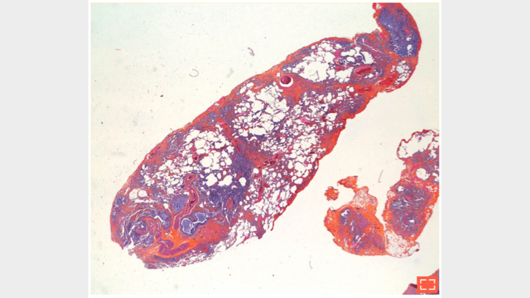 Fibrosis | Boehringer Ingelheim | Imaging Atlas
