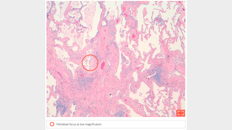 Fibrosis | Boehringer Ingelheim | Imaging Atlas