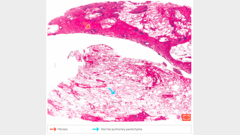 Fibrosis | Boehringer Ingelheim | Imaging Atlas