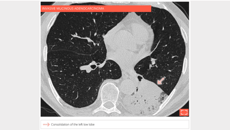 Consolidation - Elementary Lesions | Imaging Atlas