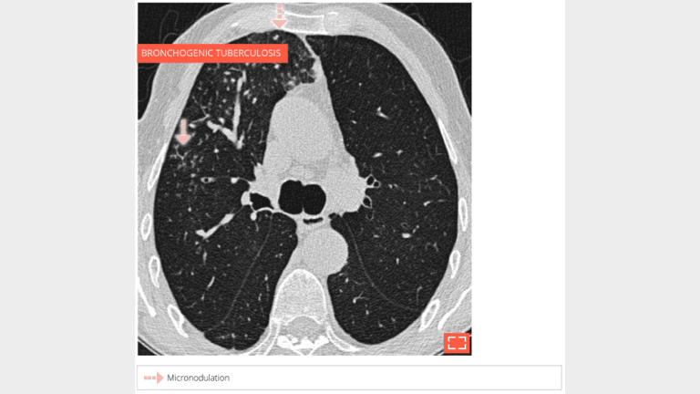 Traction bronchiectasis/ bronchiolectas | Imaging Atlas