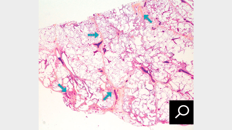 Fibrosis | Boehringer Ingelheim | Imaging Atlas