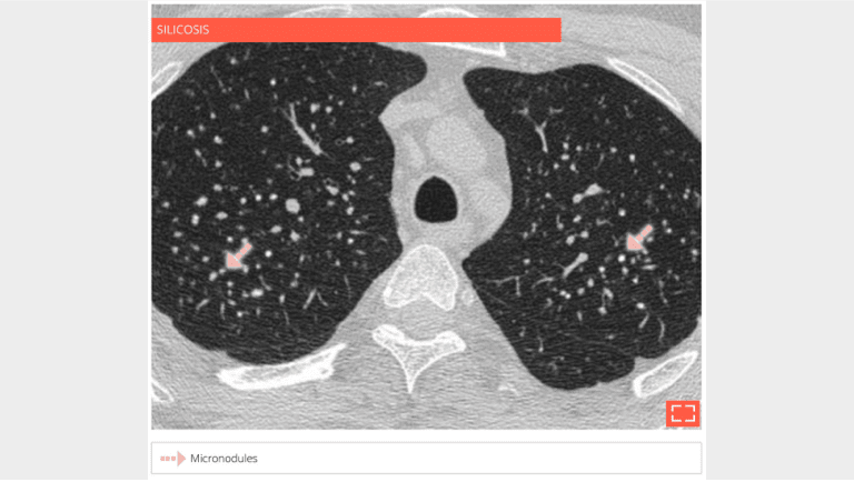 Traction bronchiectasis/ bronchiolectas | Imaging Atlas