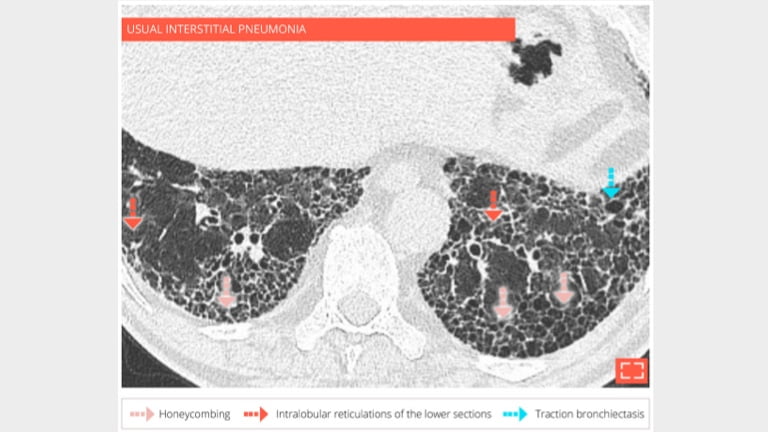 Honeycombing | Boehringer Ingelheim | Imaging Atlas