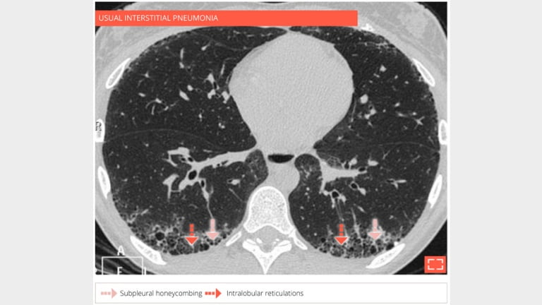 Honeycombing | Boehringer Ingelheim | Imaging Atlas