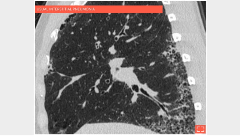Honeycombing | Boehringer Ingelheim | Imaging Atlas