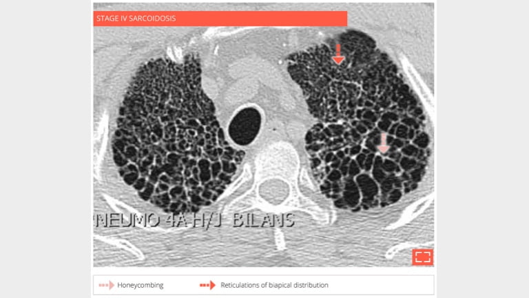 Honeycombing | Boehringer Ingelheim | Imaging Atlas