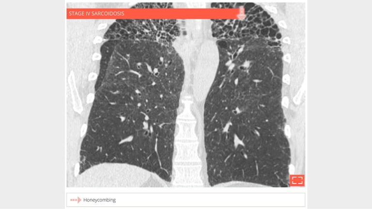 Honeycombing | Boehringer Ingelheim | Imaging Atlas
