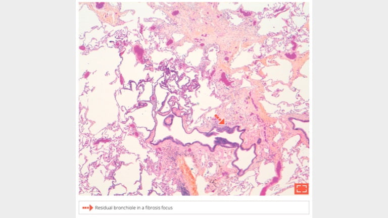 Bronchial epithelial metaplasia | Imaging Atlas