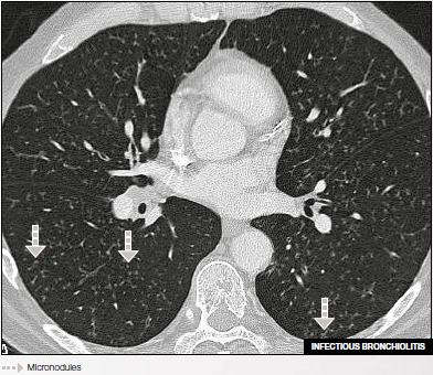 Centrilobular Micronodulation | Imaging Atlas
