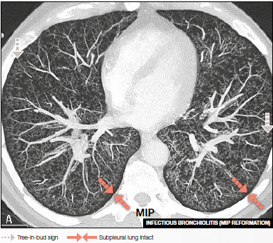 Centrilobular Micronodulation | Imaging Atlas