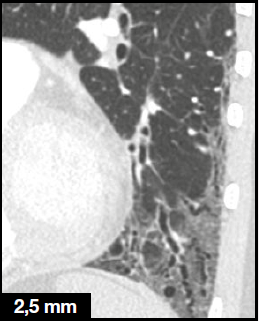 Principle of MIP and MINIP Reconstru | Imaging Atlas