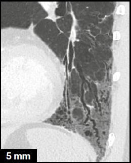 Principle of MIP and MINIP Reconstru | Imaging Atlas