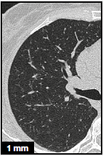 Principle of MIP and MINIP Reconstru | Imaging Atlas
