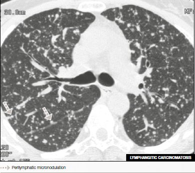 Perilymphatic Micronodulation | Imaging Atlas
