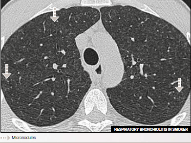 Simple Centrilobular Micronodulation | Imaging Atlas