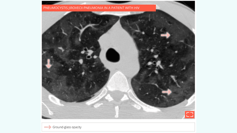 Ground-glass opacity-Elementary Lesions | Boehringer Ingelheim Danmark
