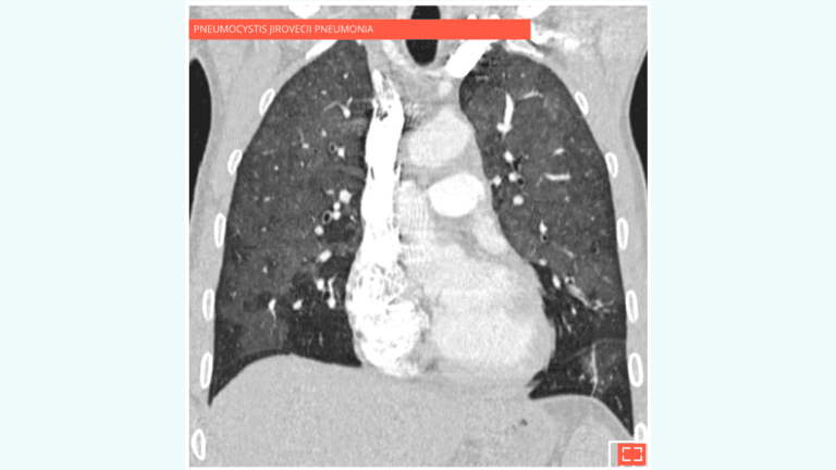 Ground-glass opacity-Elementary Lesions | Boehringer Ingelheim Danmark