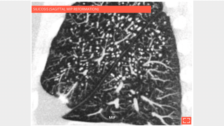 Traction bronchiectasis/ bronchiolectas | Boehringer Ingelheim Danmark