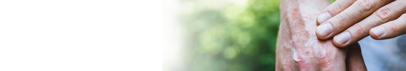 Pustular Psoriasis Overview | HCP India