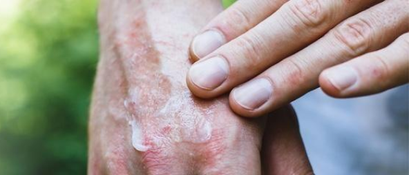 Pustular Psoriasis Overview | HCP India